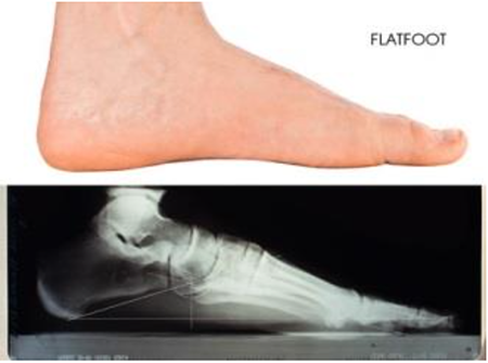 Flat Feet: What are They and Can They be Fixed?